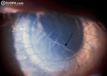 Cornea Iron Line On
